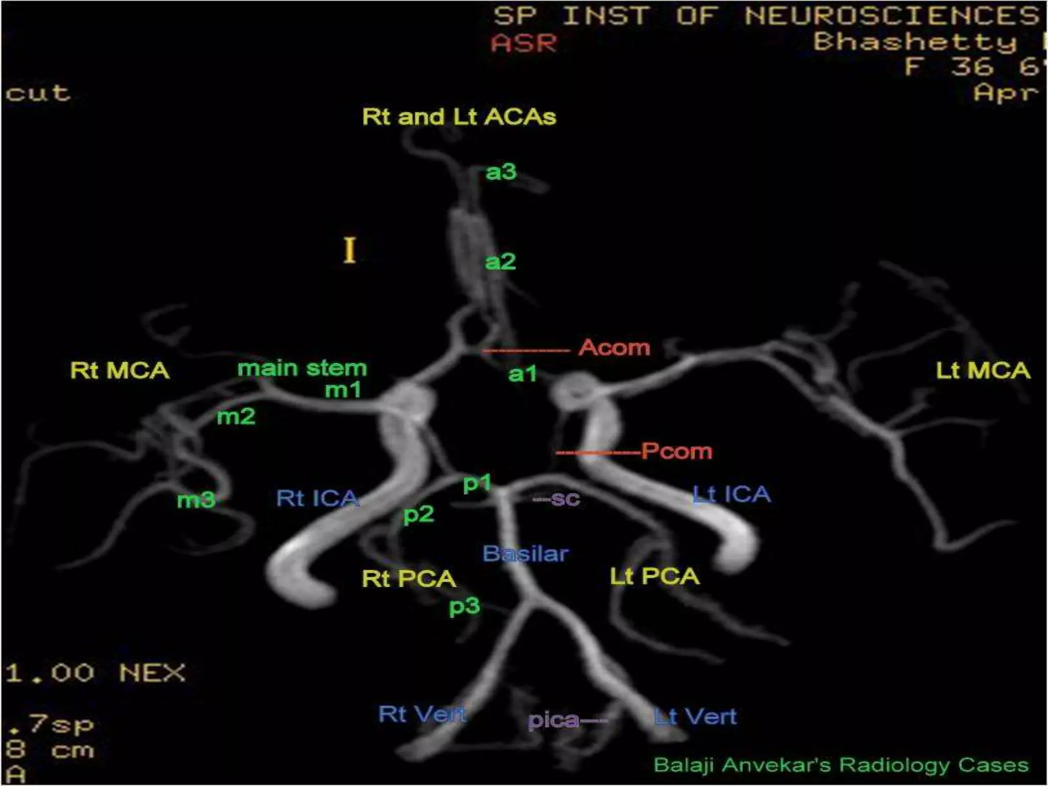 Imaging in neurology - normal MR Angio and Venography | PPTX