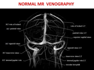 Imaging in neurology - normal MR Angio and Venography | PPTX | Medical ...