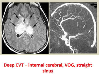 Imaging in neurology - normal MR Angio and Venography | PPTX