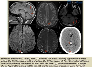 Imaging in neurology - normal MR Angio and Venography | PPTX