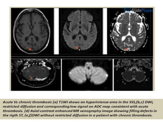 Imaging in neurology - normal MR Angio and Venography | PPTX
