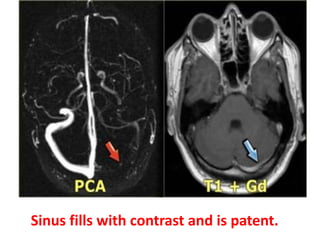 Imaging in neurology - normal MR Angio and Venography | PPTX