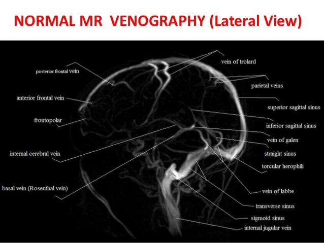 Imaging in neurology - normal MR Angio and Venography