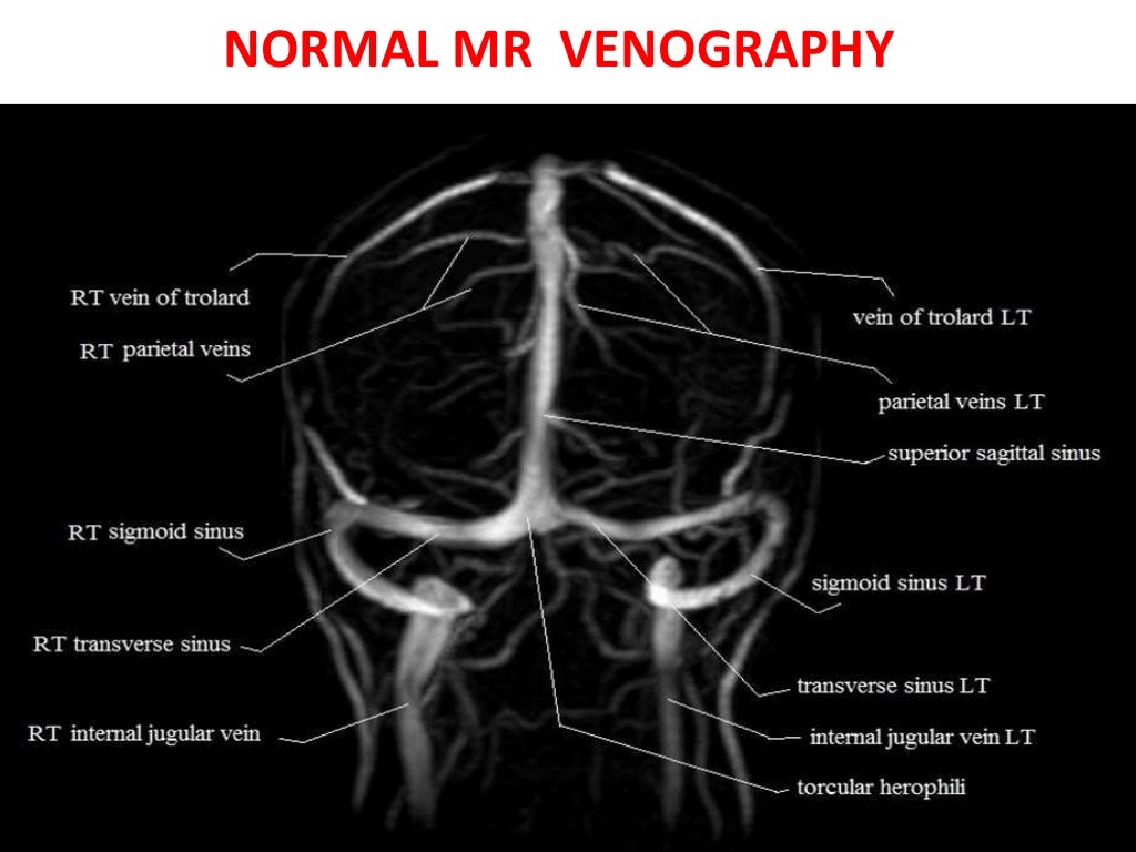 Imaging in neurology - normal MR Angio and Venography