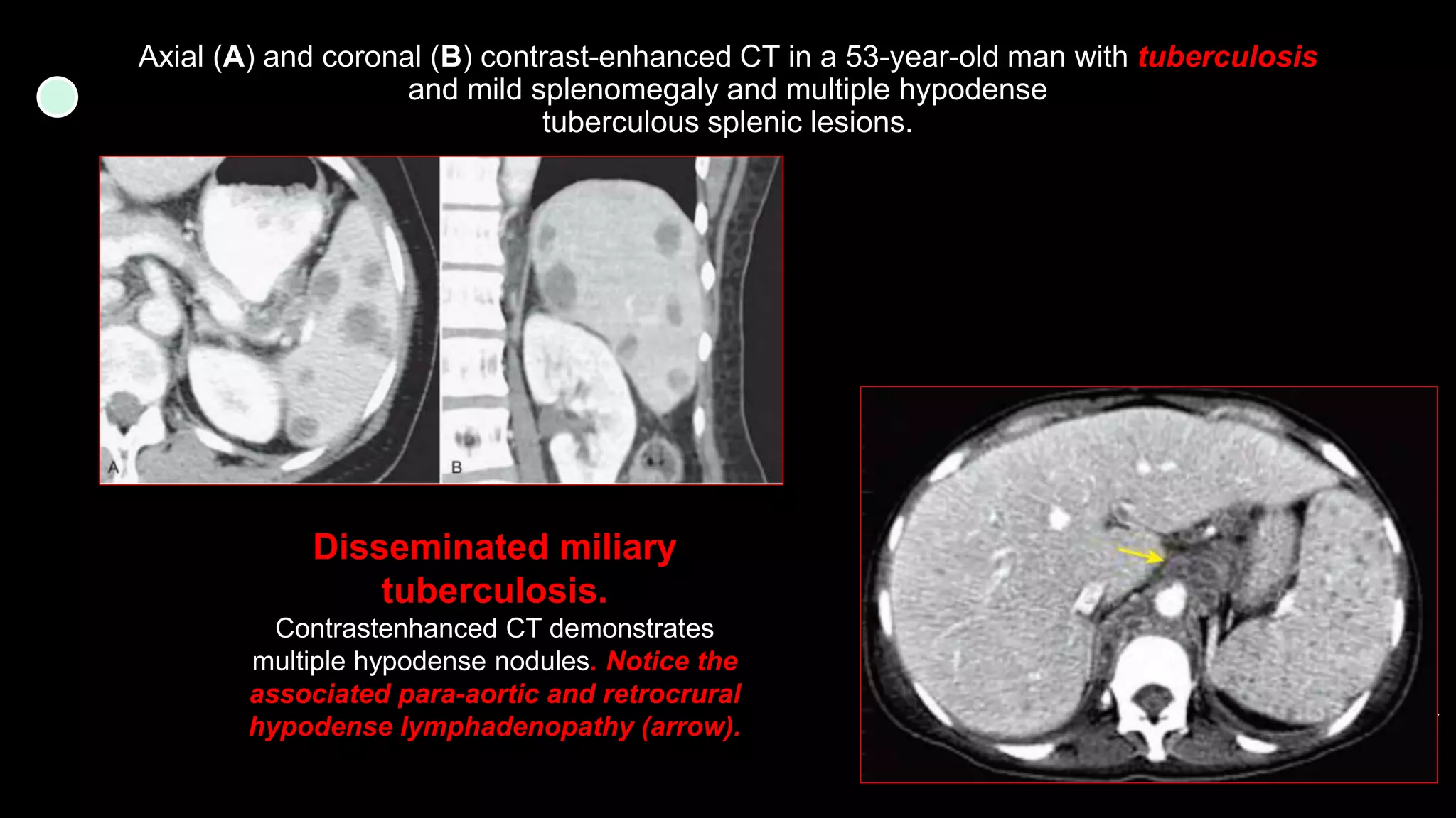 Imaging ofsplenic diseases [Autosaved].pptx