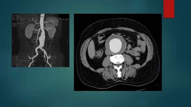 IMAGING OF AAA.pptx