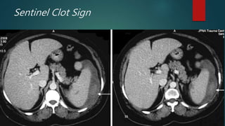Imaging of abdominal trauma | PPT