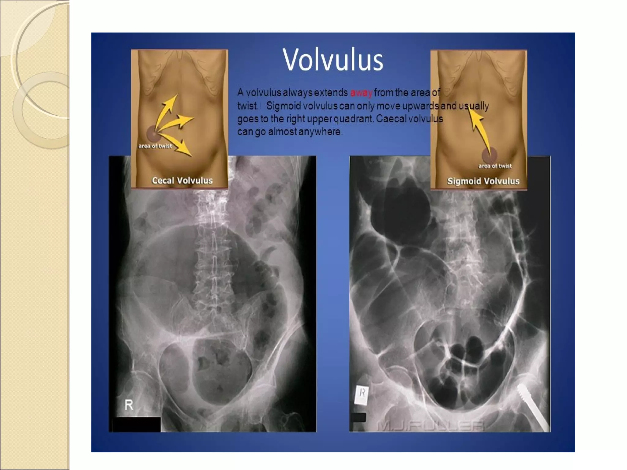 Imaging of acute abdomen | PPT