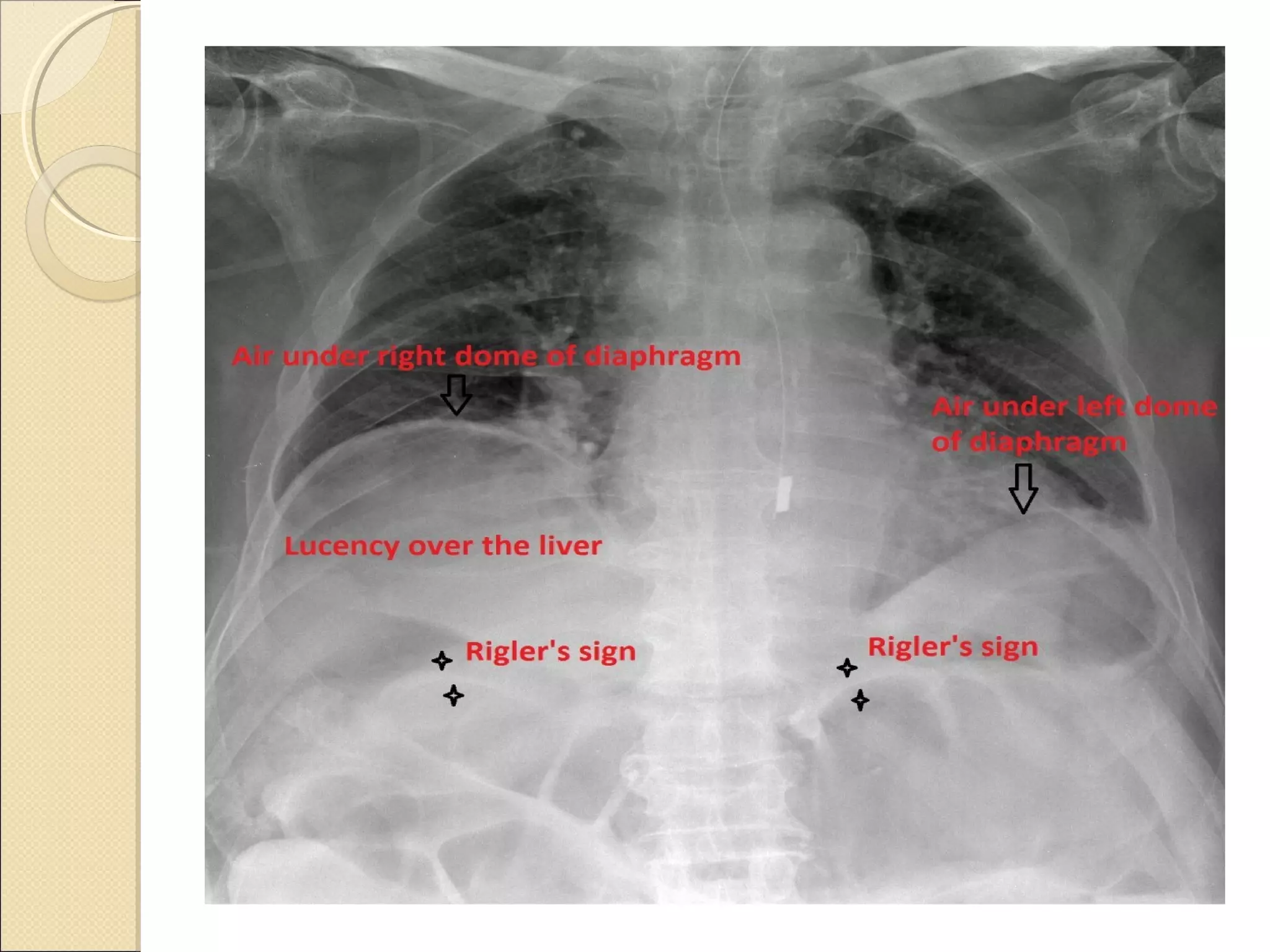 Imaging of acute abdomen | PPT