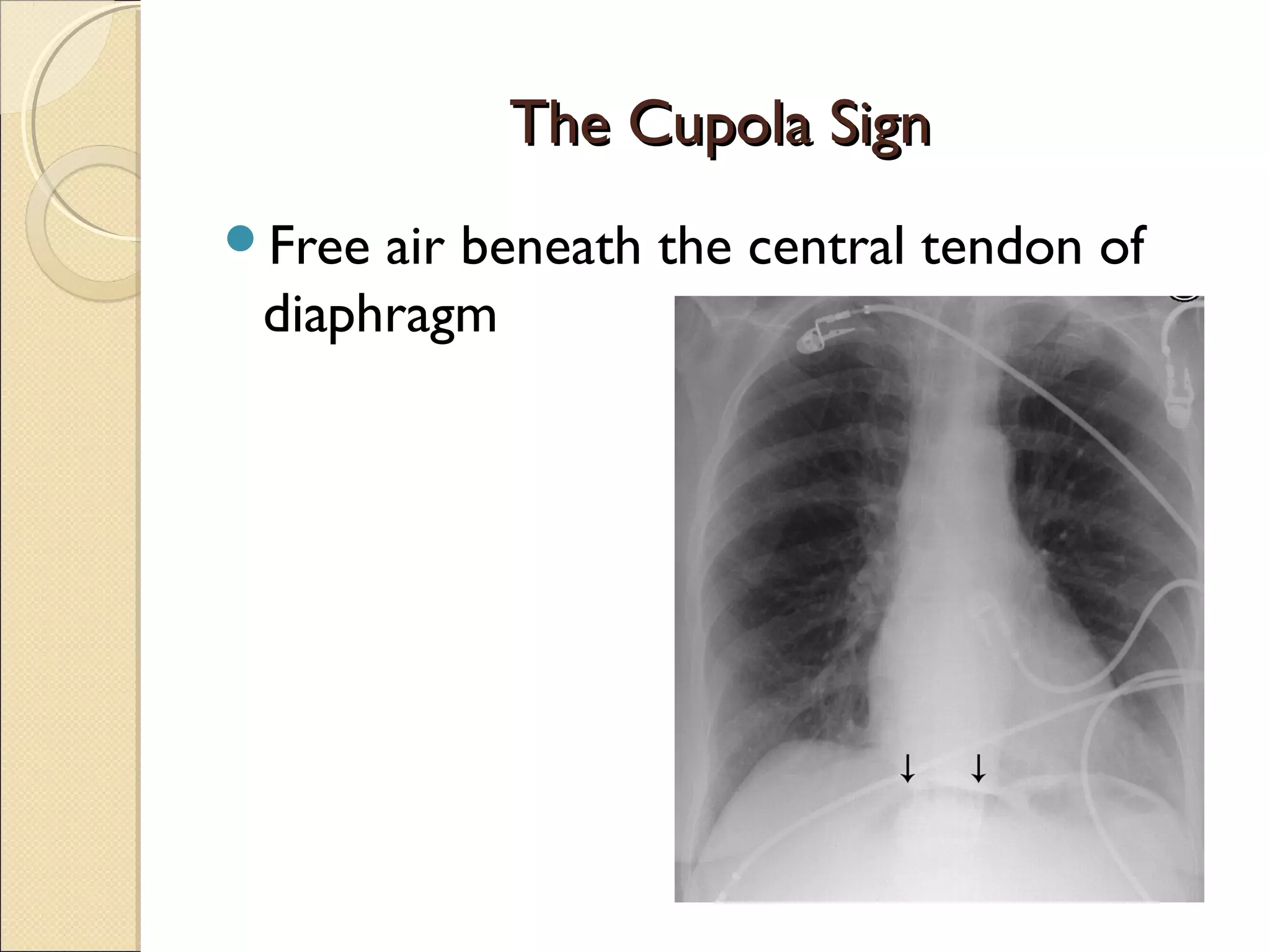 Imaging of acute abdomen | PPT