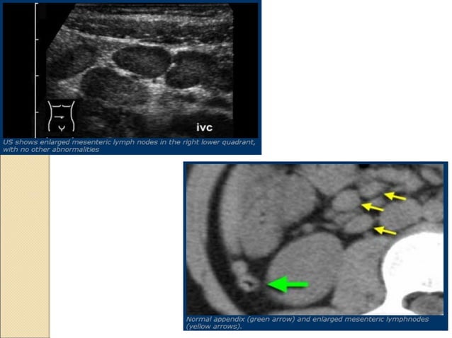Imaging of acute abdomen | PPT | Digestive Disorders | Diseases and ...