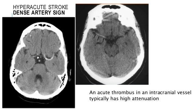Imaging of acute stroke , Interventions