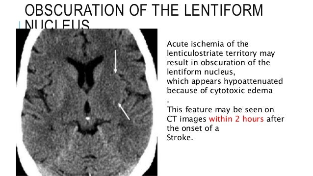 Imaging of acute stroke , Interventions