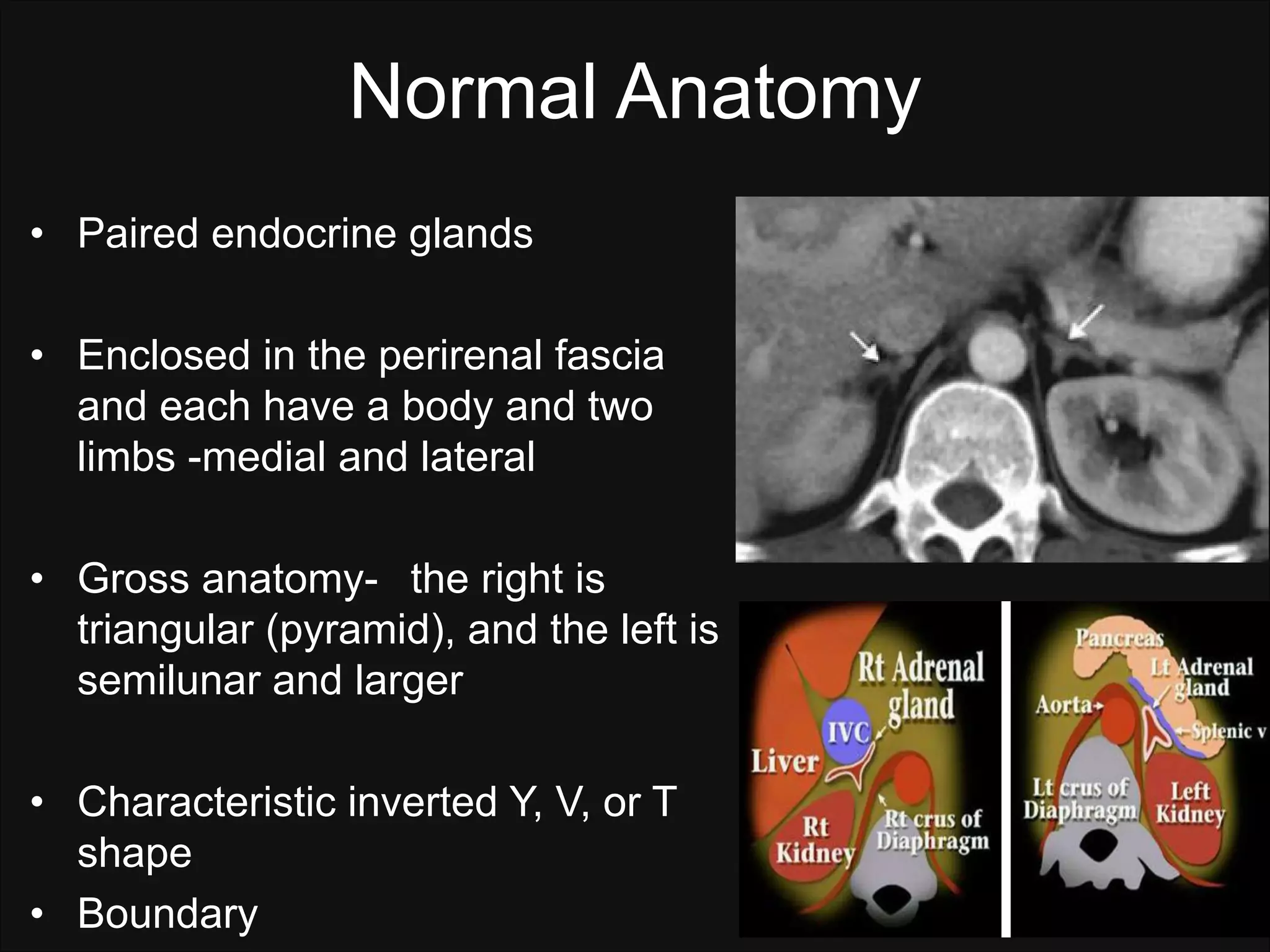 Imaging of adrenal masses abdulj final | PDF