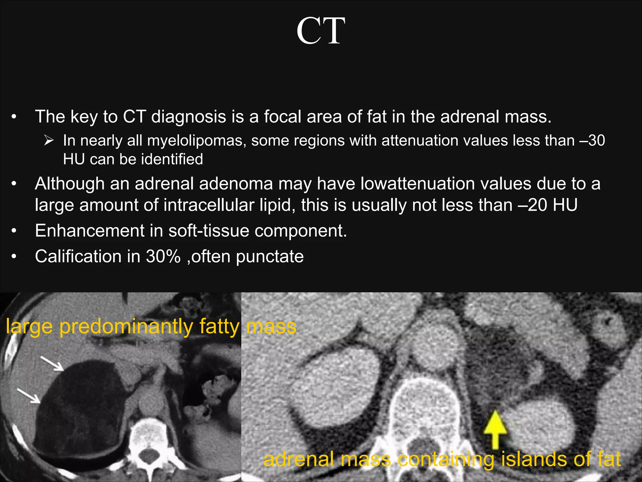Imaging of adrenal masses abdulj final | PDF
