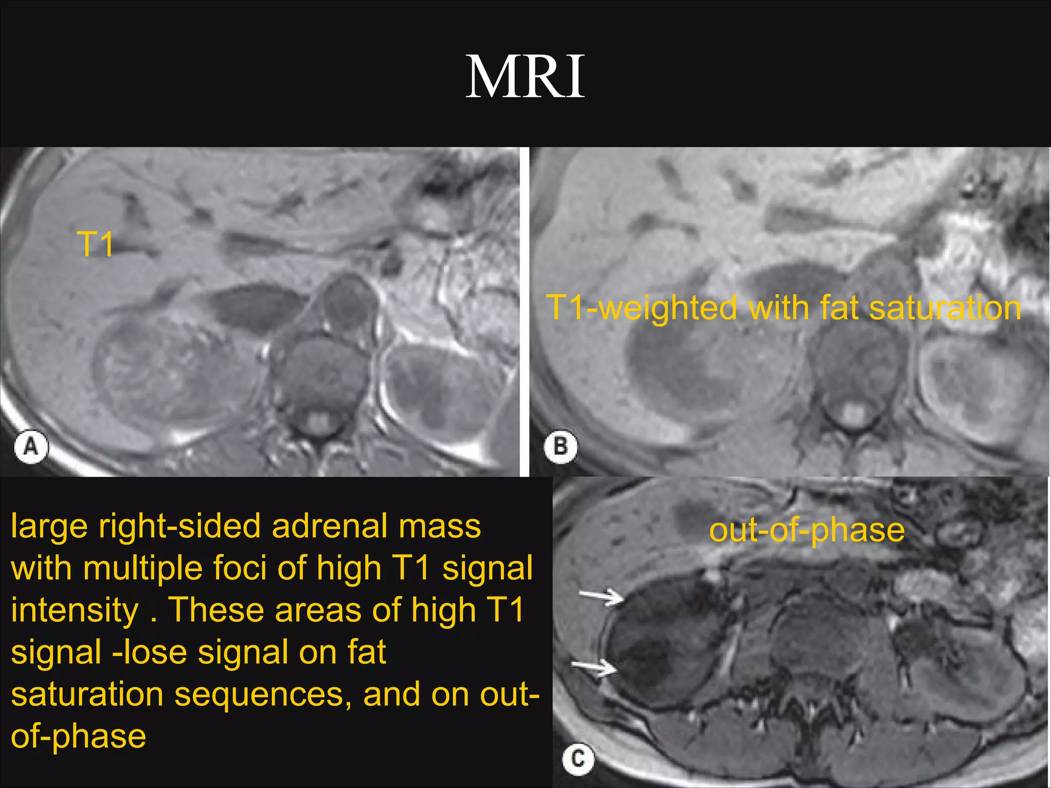 Imaging of adrenal masses abdulj final | PDF