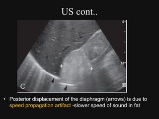 Imaging of adrenal masses abdulj final | PDF