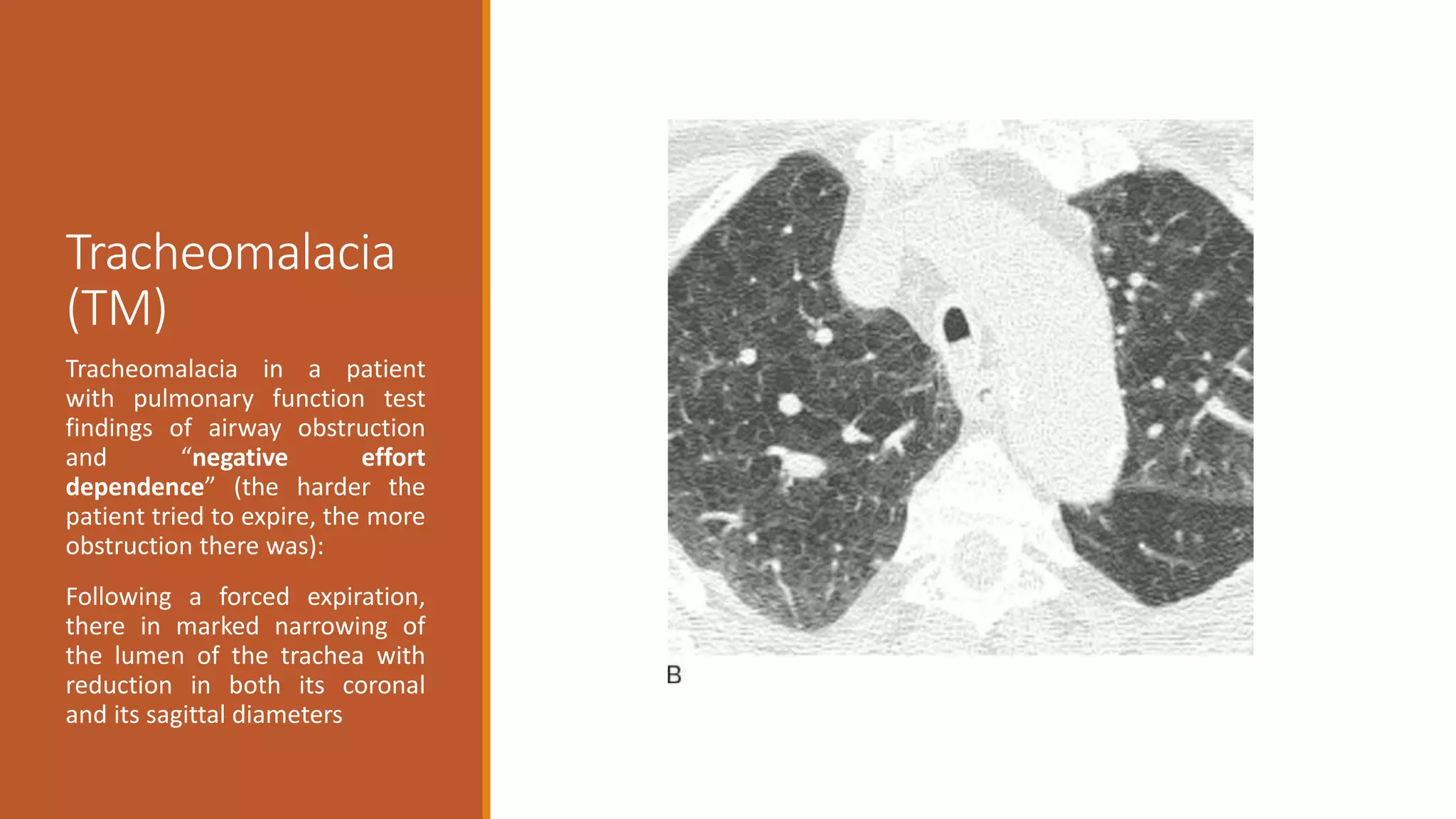 Imaging of Airway Diseases | PPTX
