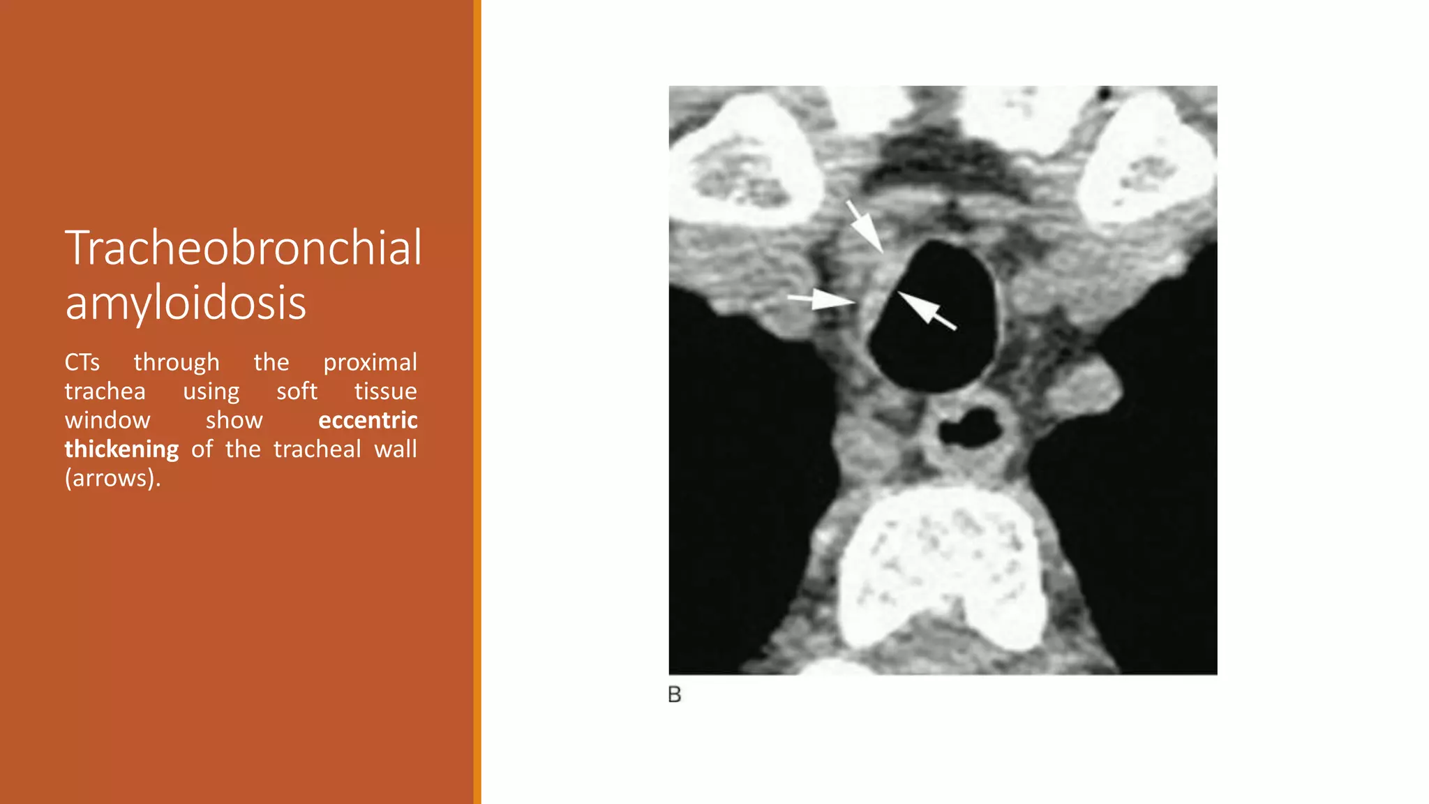 Imaging of Airway Diseases | PPTX