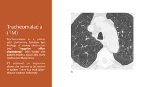 Imaging of Airway Diseases | PPTX