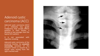Imaging of Airway Diseases | PPTX