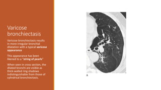 Imaging of Airway Diseases | PPTX