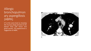 Imaging of Airway Diseases | PPTX