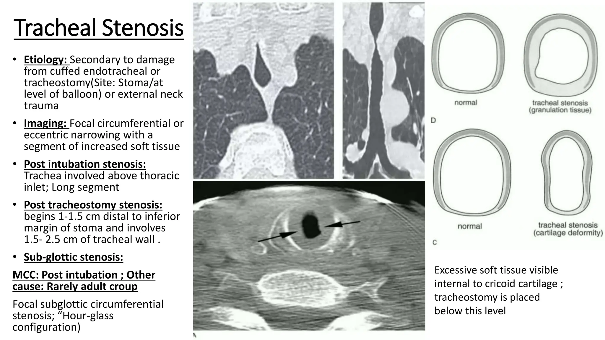Imaging of large and small airway diseases.pptx