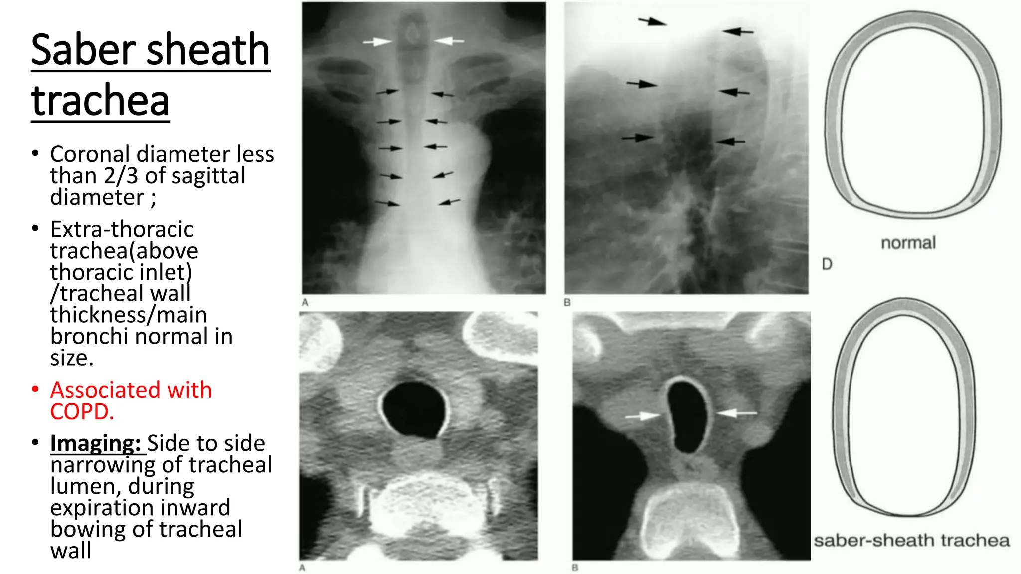 Imaging of large and small airway diseases.pptx
