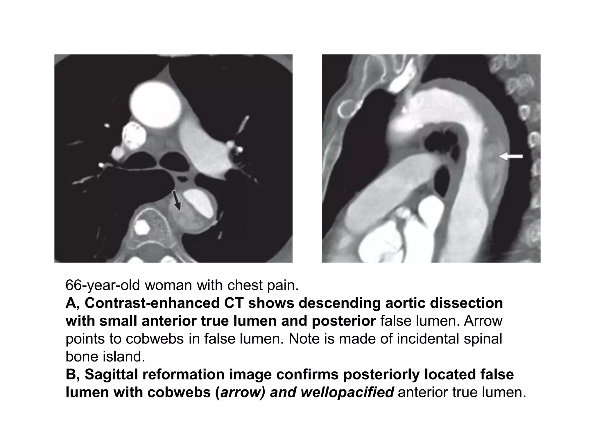 Imaging of aortic pathologies | PPTX