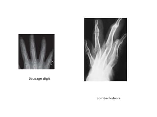 Imaging of arthritis.pptx