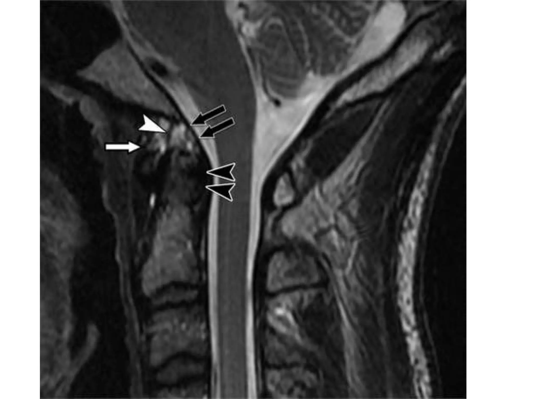 Imaging of atlanto occipital and atlantoaxial traumatic injuries | PPTX