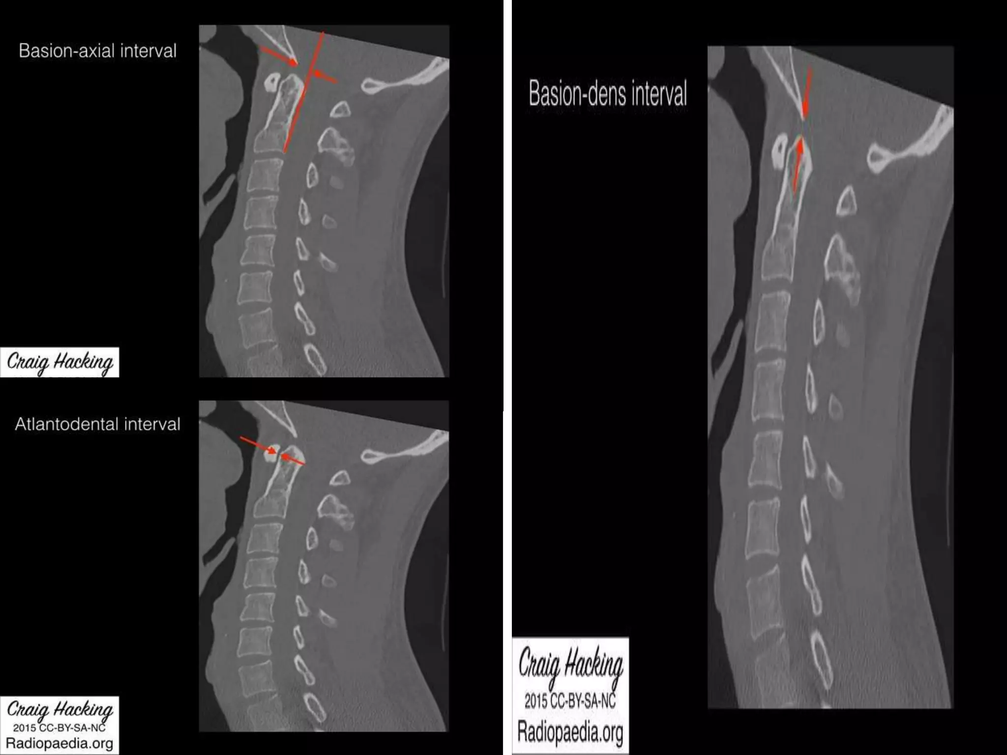 Imaging of atlanto occipital and atlantoaxial traumatic injuries | PPTX