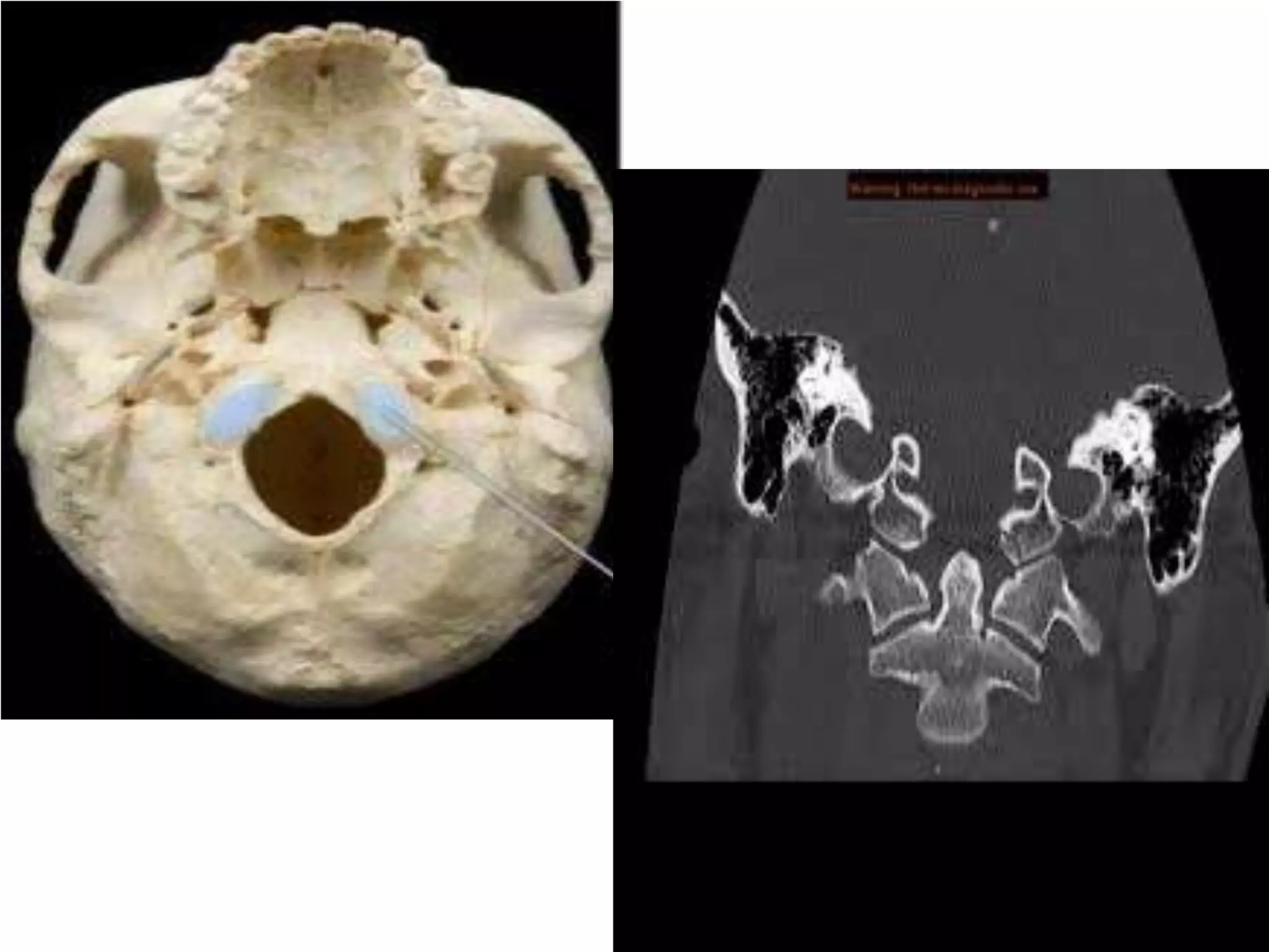 Imaging of atlanto occipital and atlantoaxial traumatic injuries | PPTX
