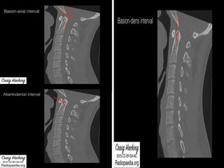 Atlantoaxial Joint Xray