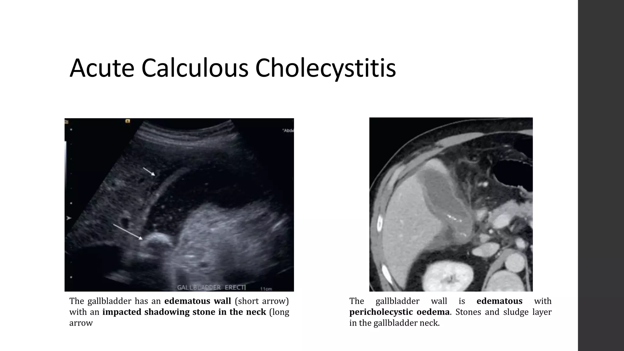 Imaging of the Biliary System and its Disorders | PPTX