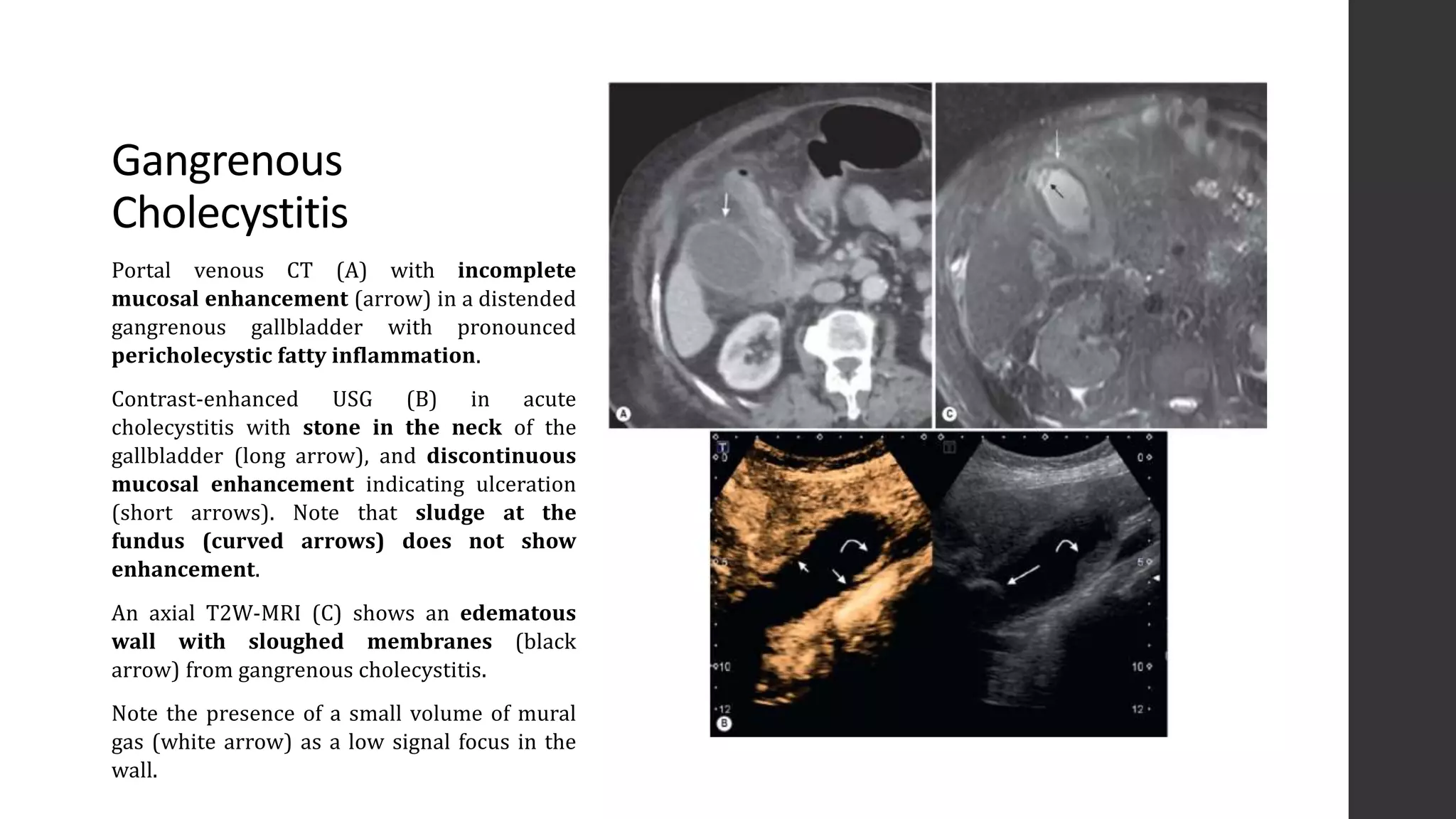 Imaging of the Biliary System and its Disorders | PPTX