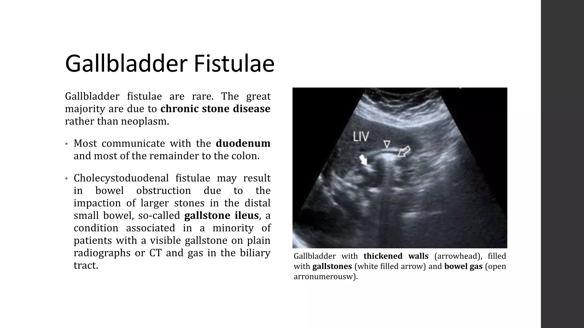 Imaging of the Biliary System and its Disorders | PPTX