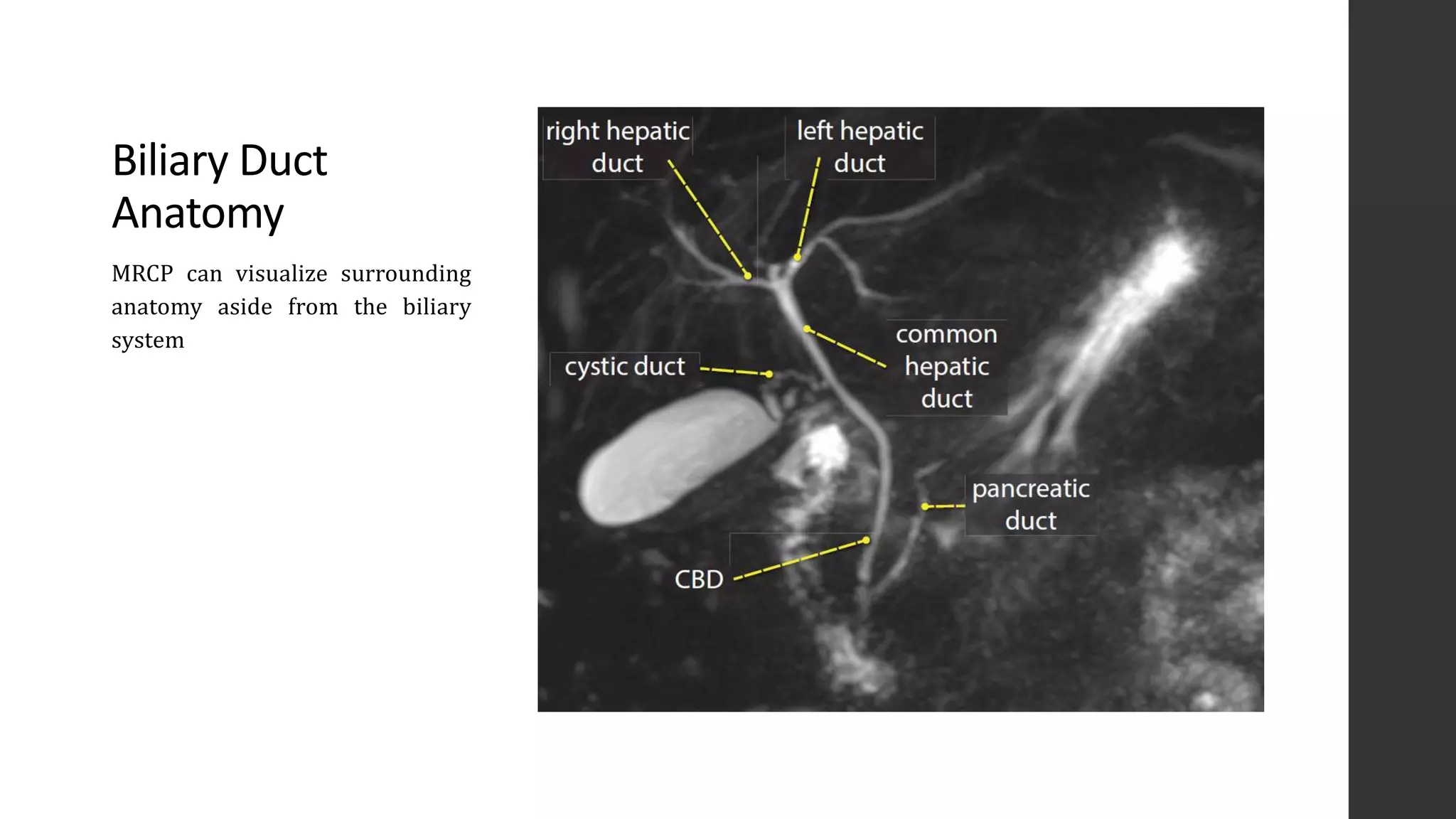 Imaging of the Biliary System and its Disorders | PPTX