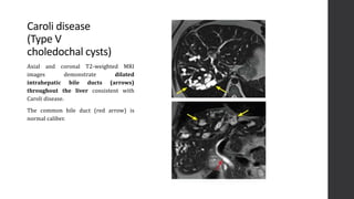 Imaging of the Biliary System and its Disorders | PPTX