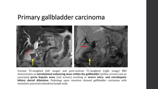 Imaging of the Biliary System and its Disorders | PPTX