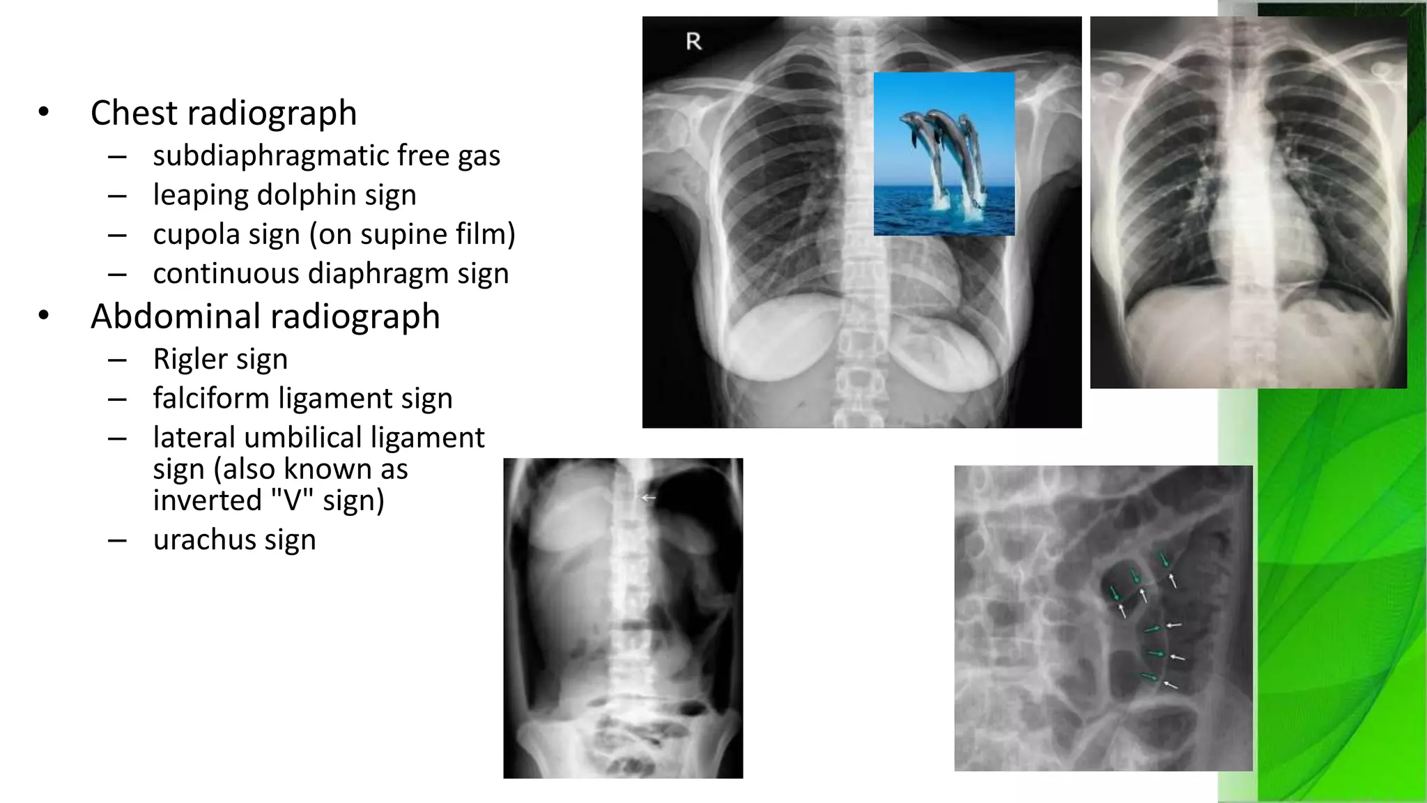 Imaging of blunt abdominal trauma.pptx
