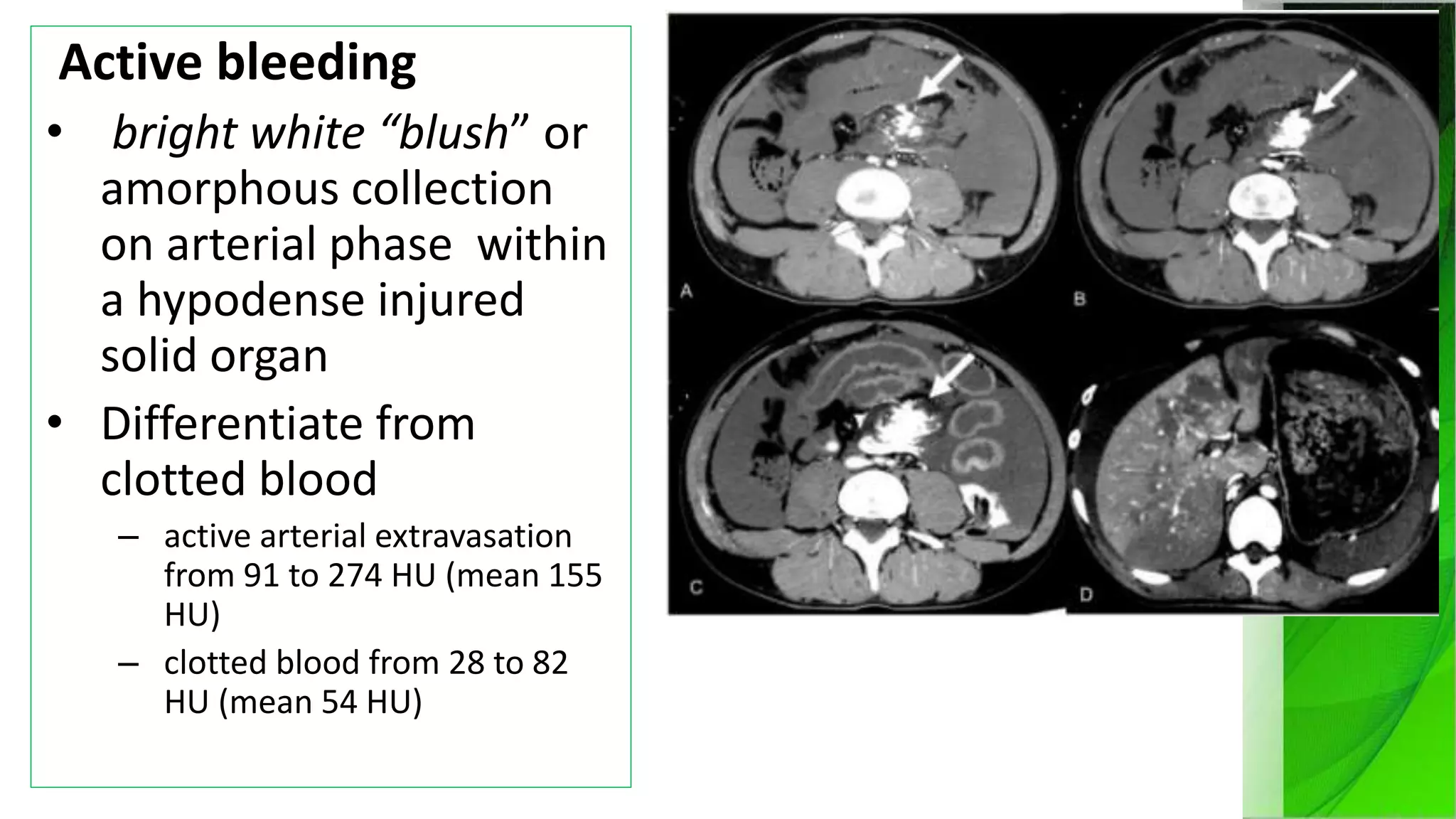 Imaging of blunt abdominal trauma.pptx