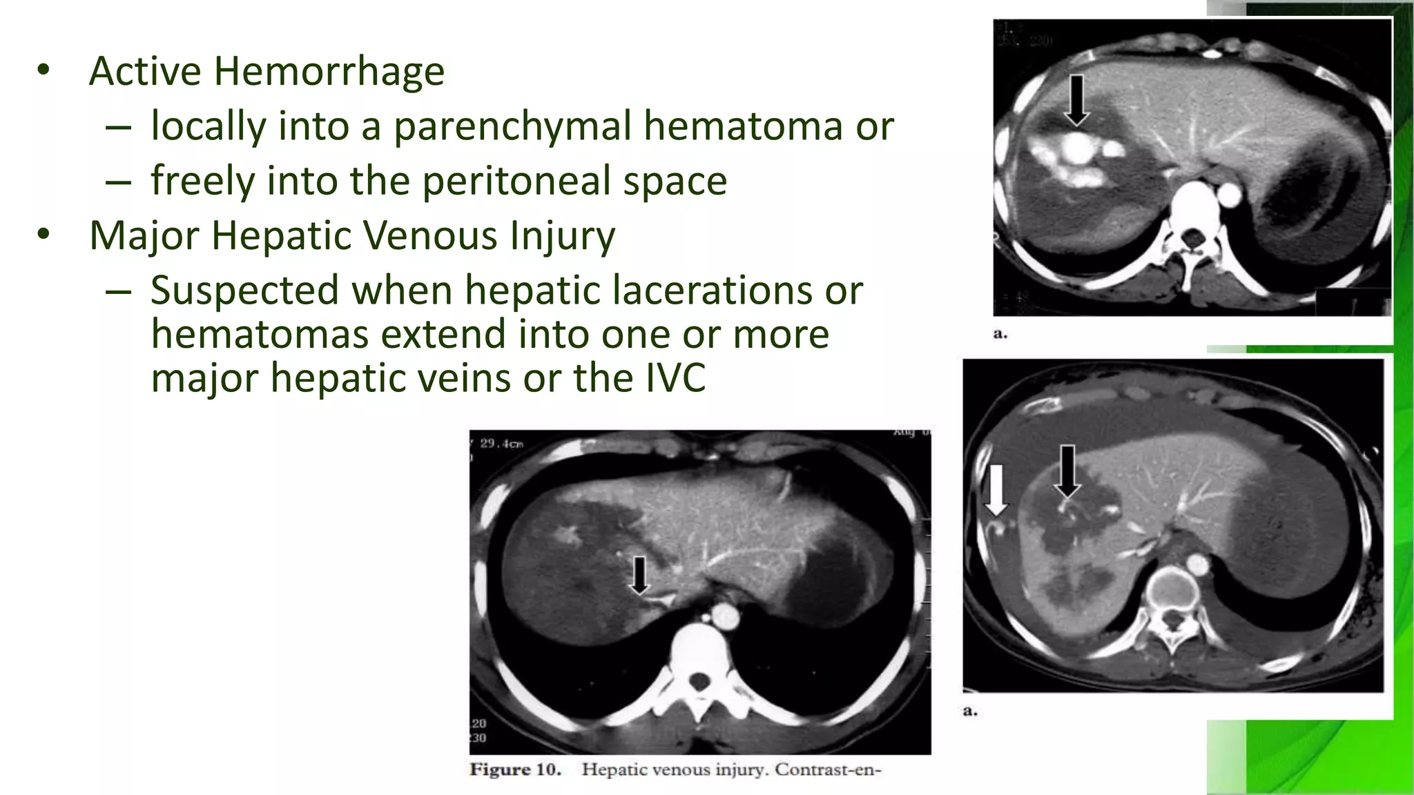 Imaging of blunt abdominal trauma.pptx