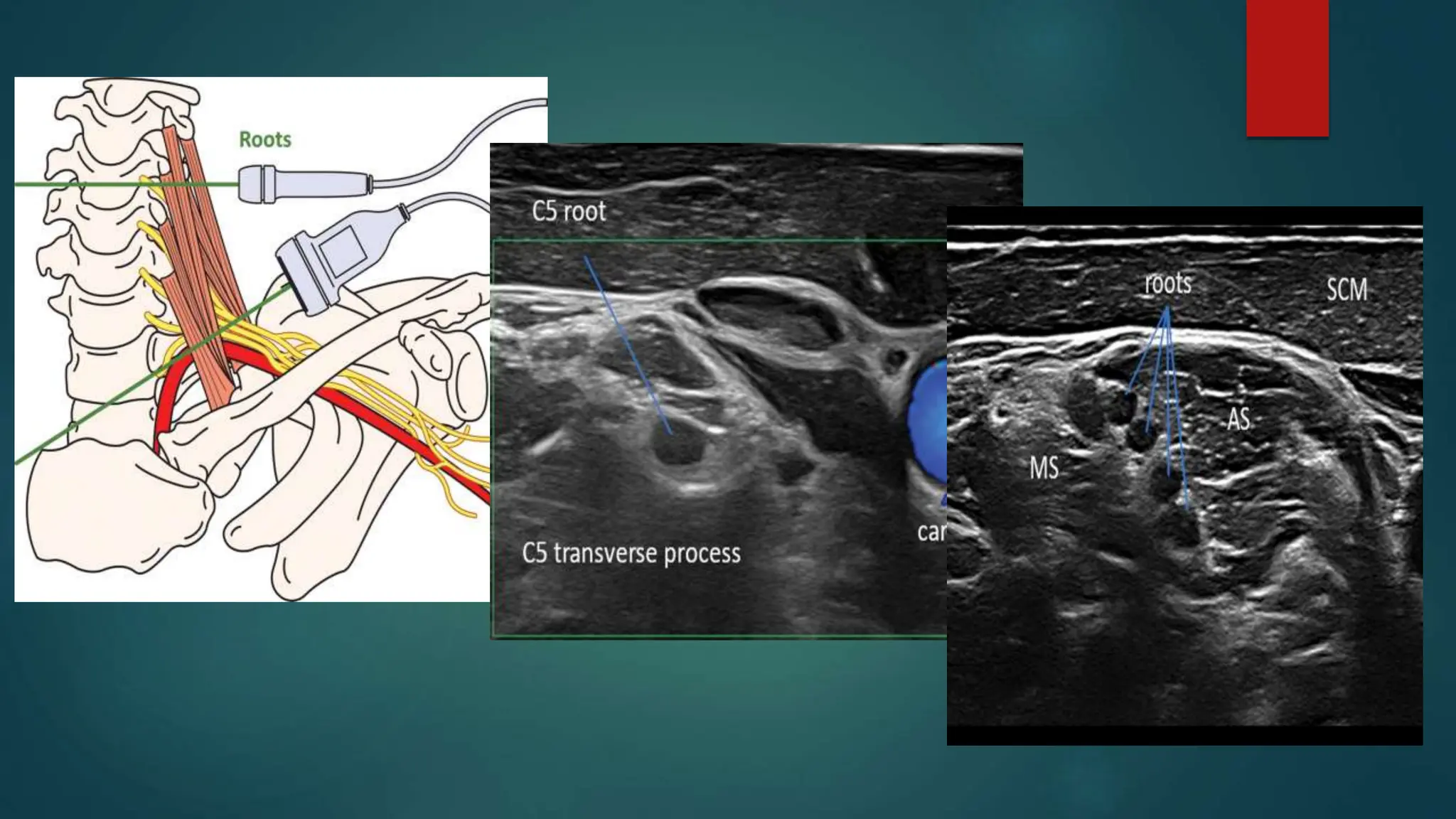 Imaging of brachial plexus.Radiology pptx | PPTX