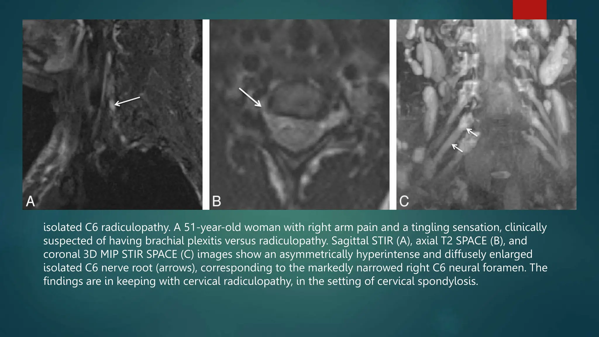 Imaging of brachial plexus.Radiology pptx | PPTX