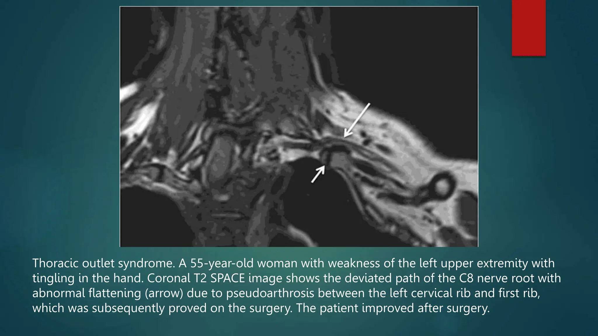 Imaging of brachial plexus.Radiology pptx | PPTX