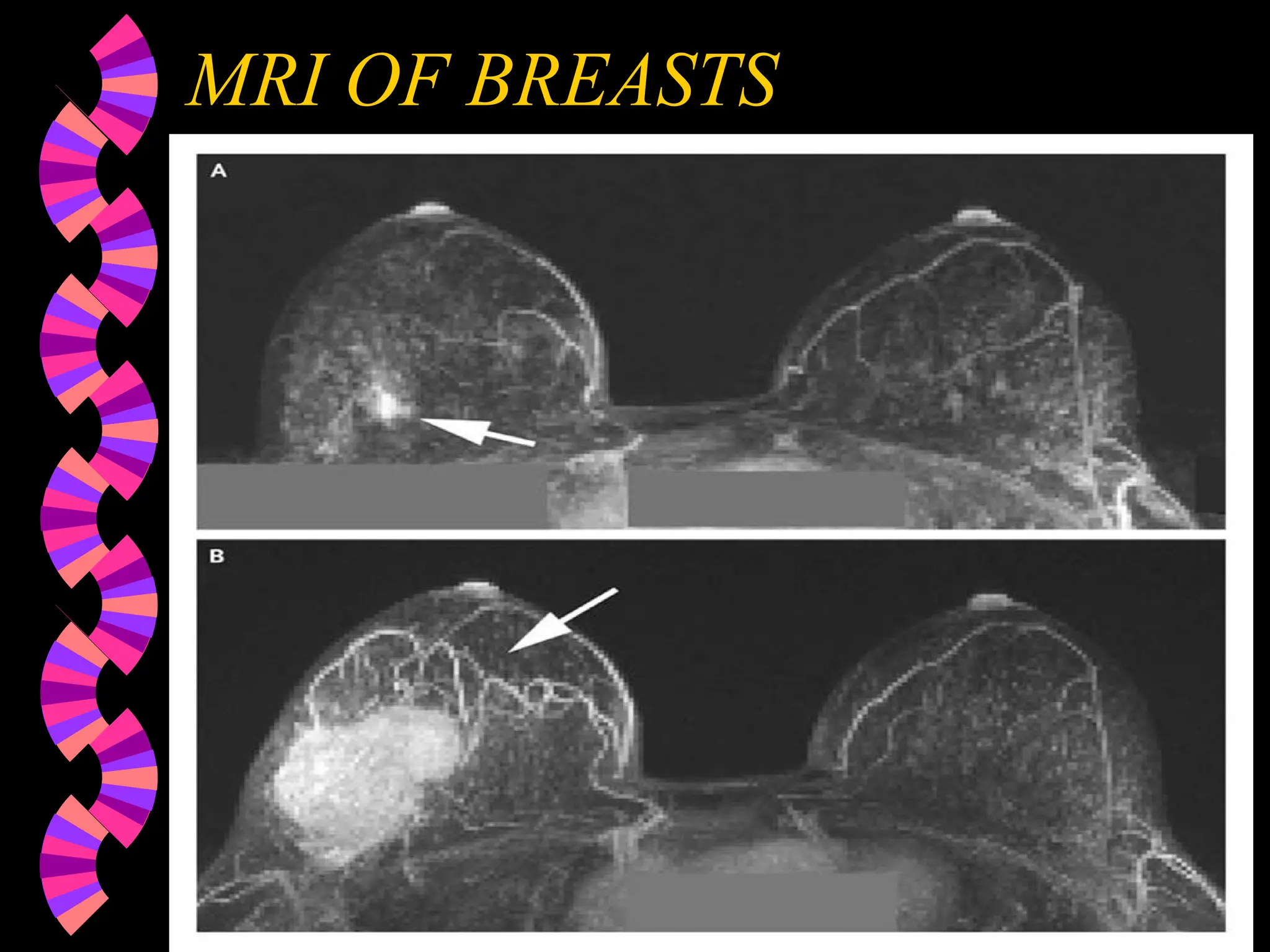 IMAGING OF BREAST DISORDERS............. | PPT