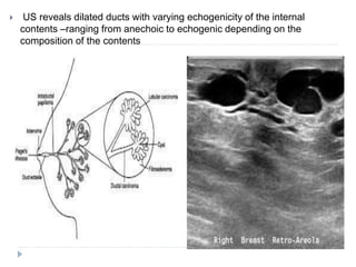 Imaging of breast pathologies | PPTX
