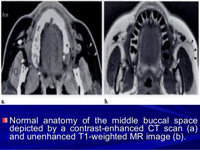 Imaging of buccal space